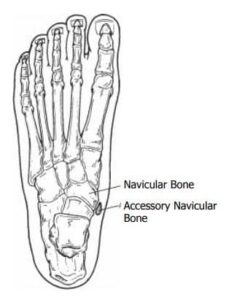 Accessory Navicular Bones – Children's Orthopaedic and Scoliosis ...