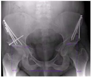 Adolescent Hip Dysplasia – Children's Orthopaedic and Scoliosis Surgery ...