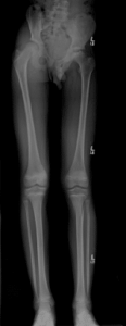 Leg Length Discrepancy (LLD) – Children's Orthopaedic and Scoliosis ...