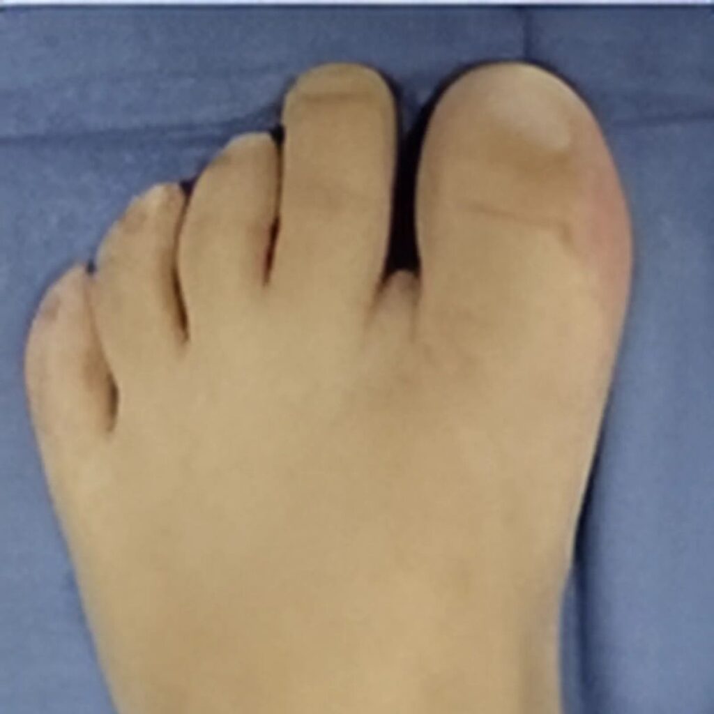Congenital Deformities of the Hands and Feet – Children's Orthopaedic ...