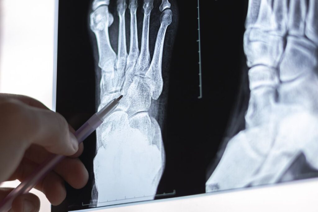 Foot Deformities in Cerebral Palsy Patients – Children's Orthopaedic ...