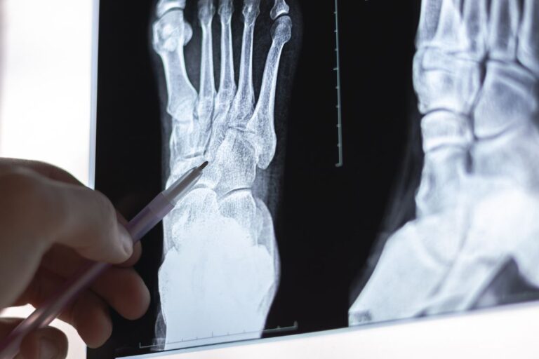 Foot Deformities in Cerebral Palsy Patients – Children's Orthopaedic ...