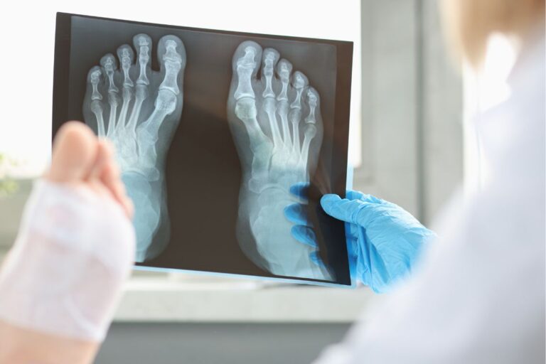 Foot Deformities in Cerebral Palsy Patients – Children's Orthopaedic ...