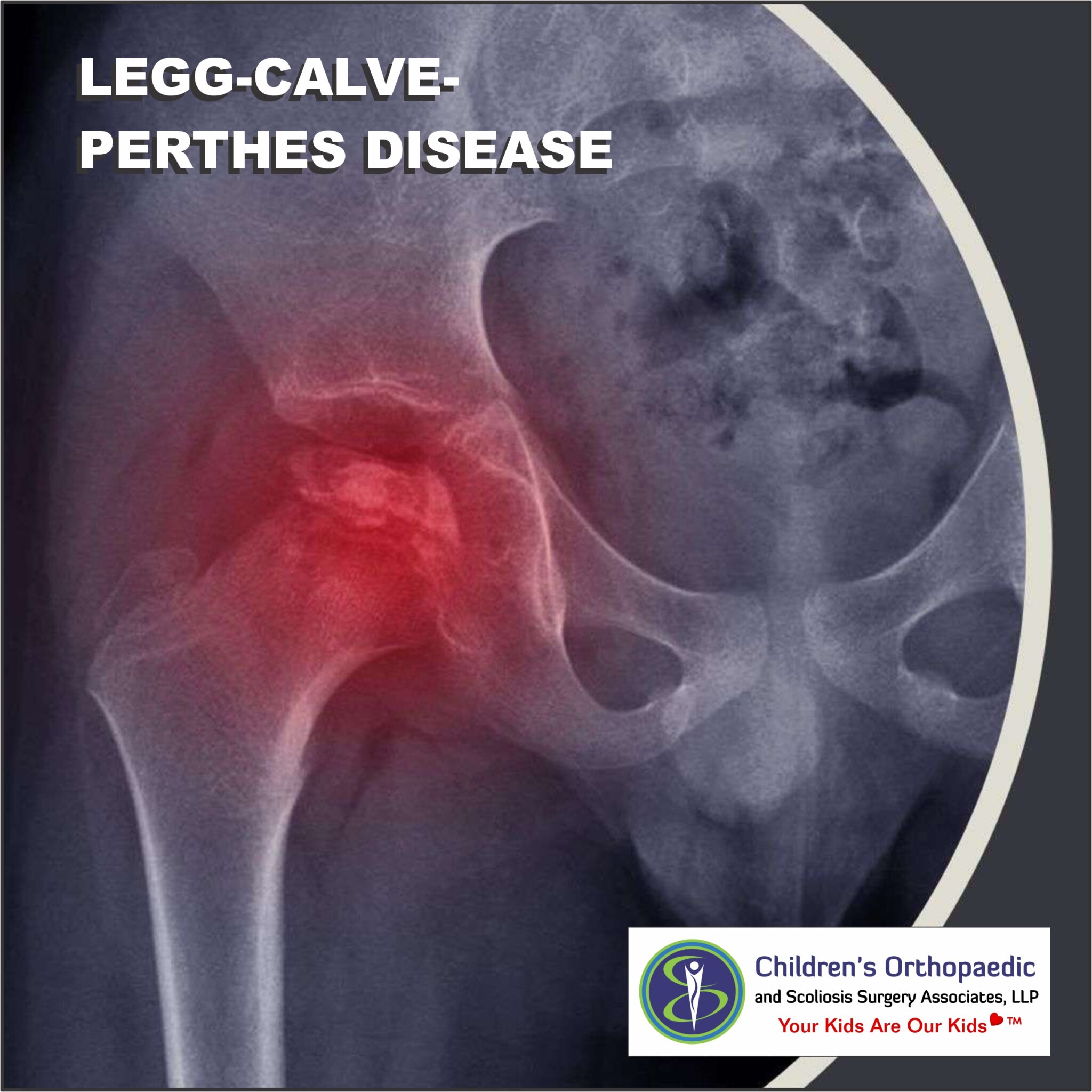 Understanding Perthes Disease: A Childhood Hip Disorder – Children's ...